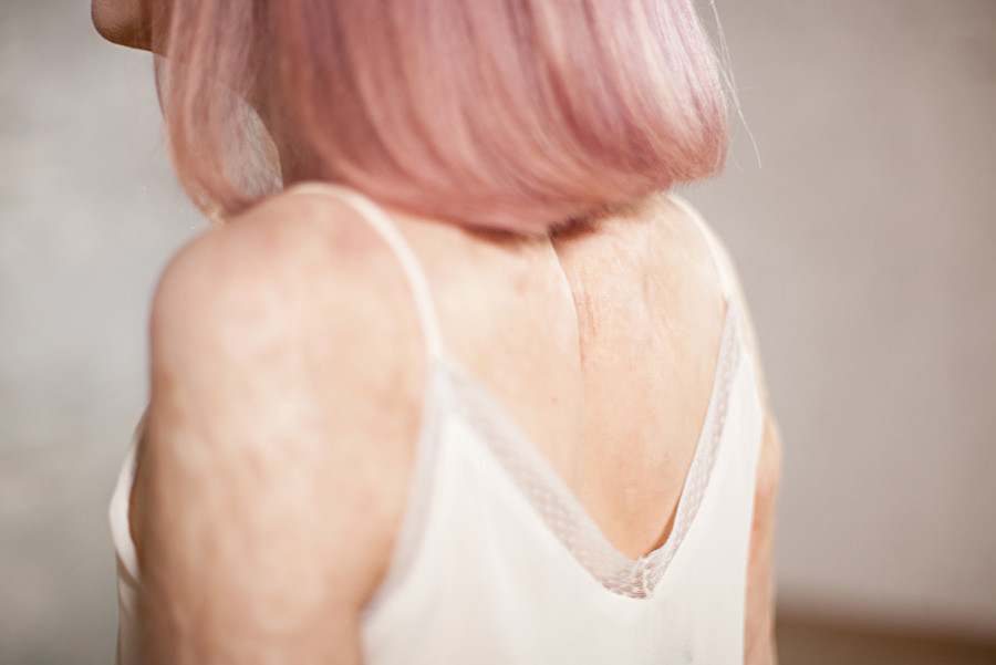 Re-imagining beauty: How body burns and anguish brought a Russian ...