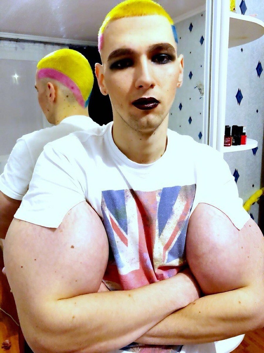 Com risco de bíceps explodirem, ‘Popeye russo’ passa por cirurgia para ...